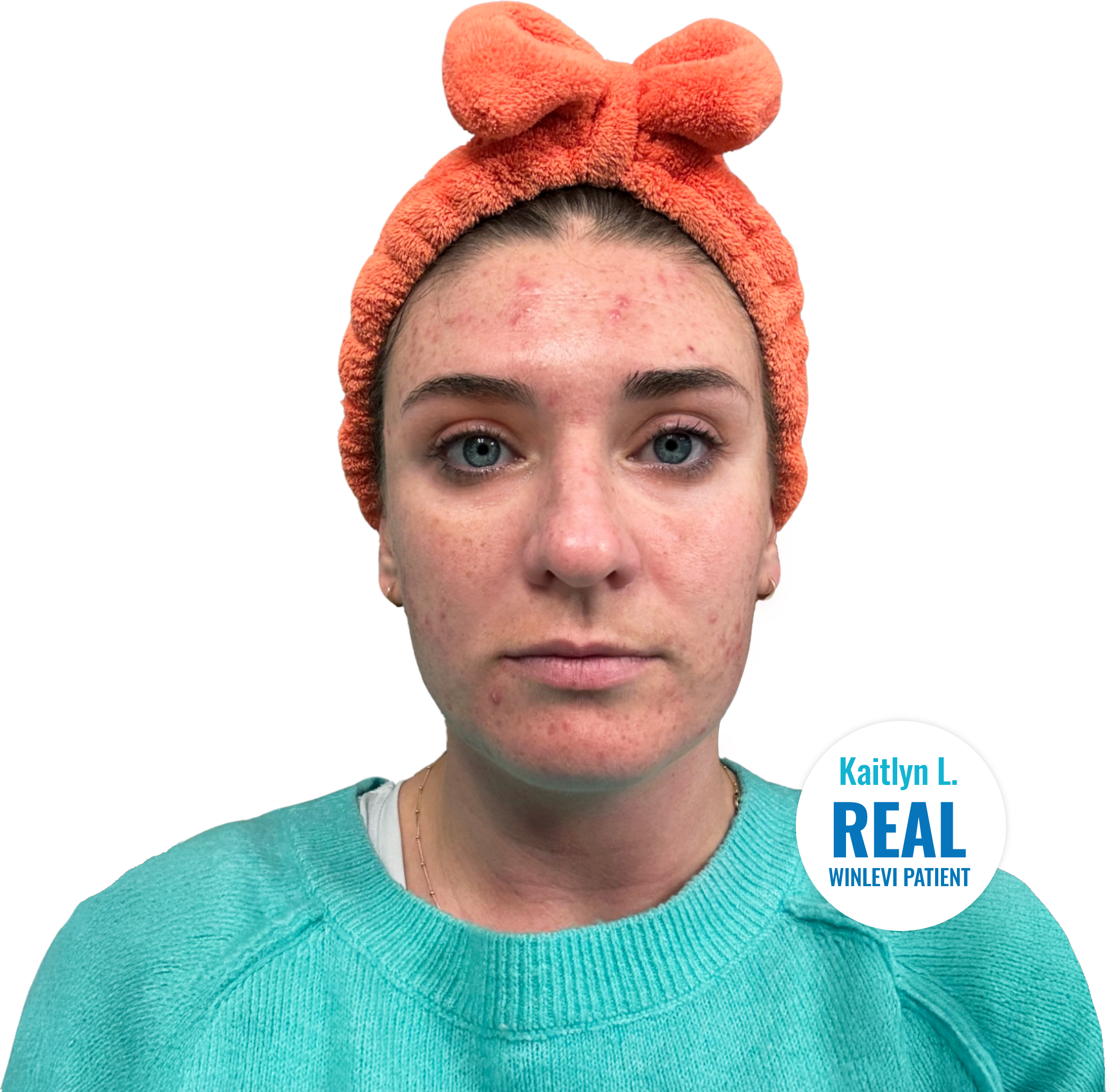 How It Works | WINLEVI® (clascoterone) cream 1% for HCPs