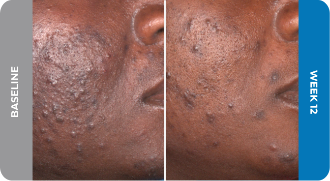 Efficacy | WINLEVI® (clascoterone) cream 1% for HCPs