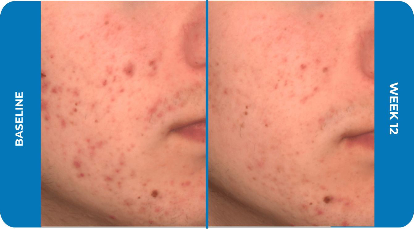 Efficacy | WINLEVI®